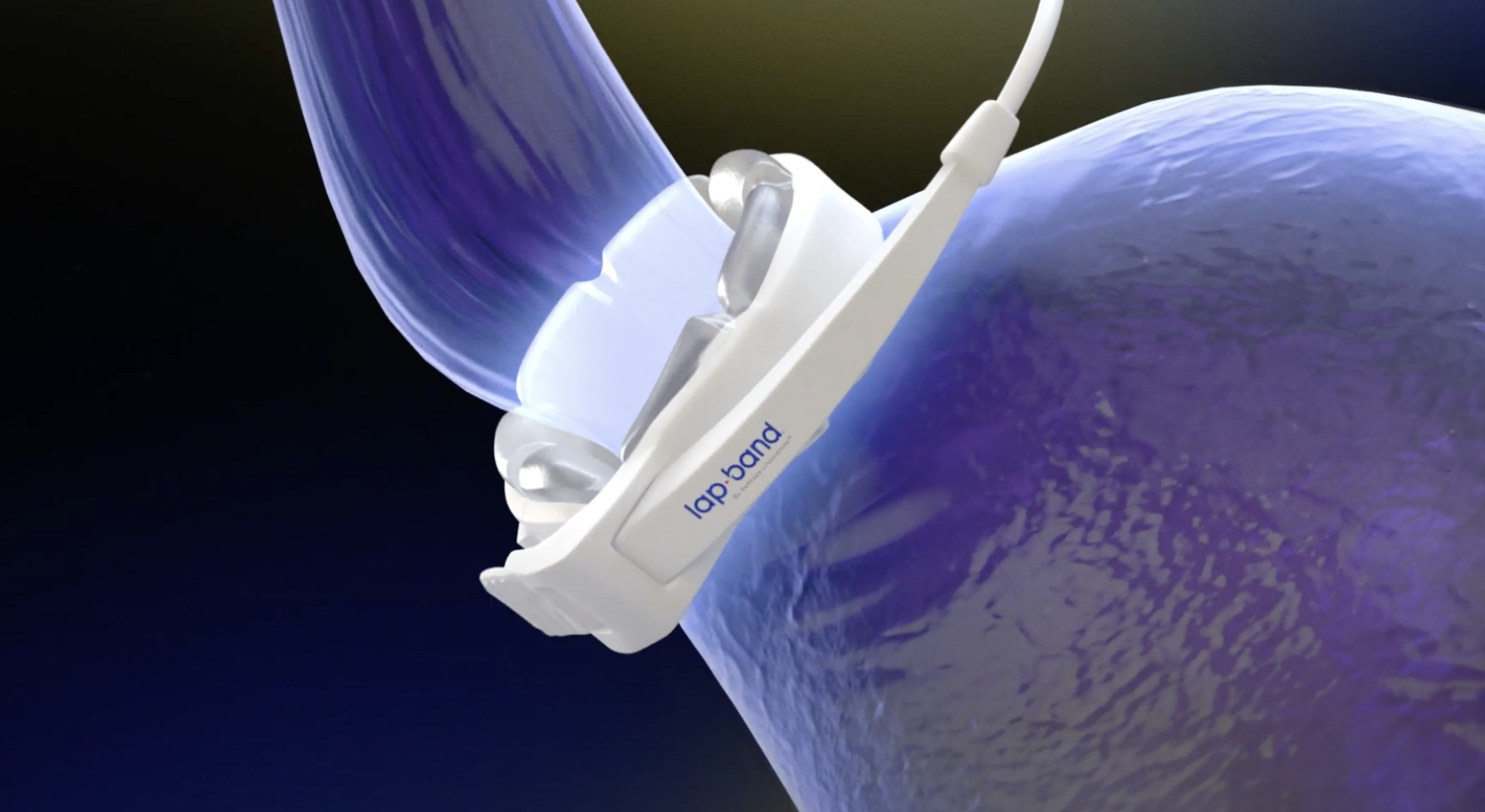 Lap-Band Doctors Near Me | Adjustable Surgeons